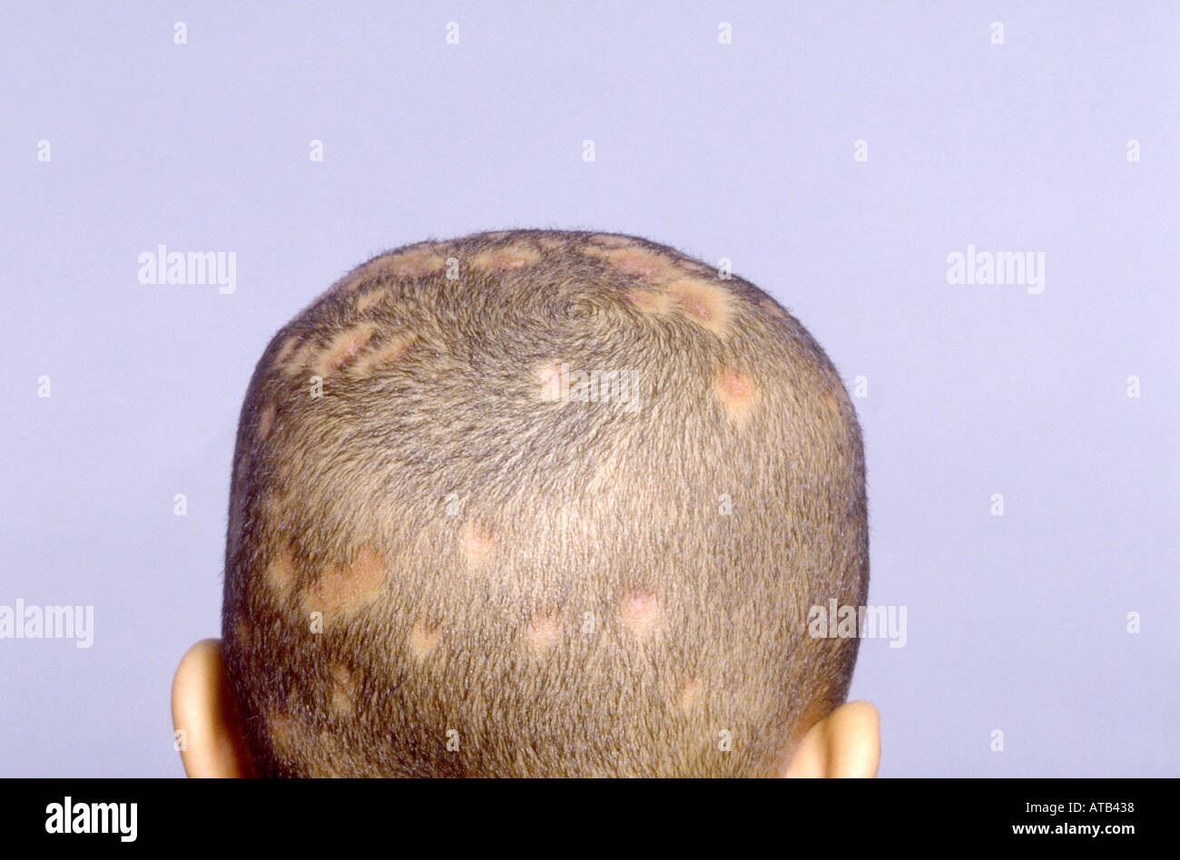 Trichophyton violaceum infection Stock Photo: 1684535 - Alamy