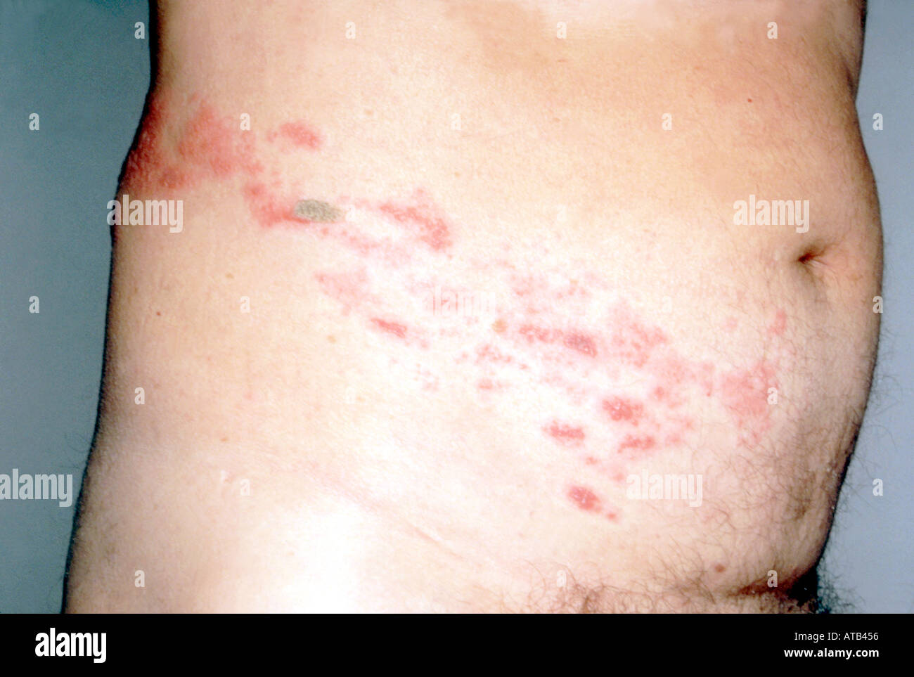 Vesicles with shingles hi-res stock photography and images - Alamy