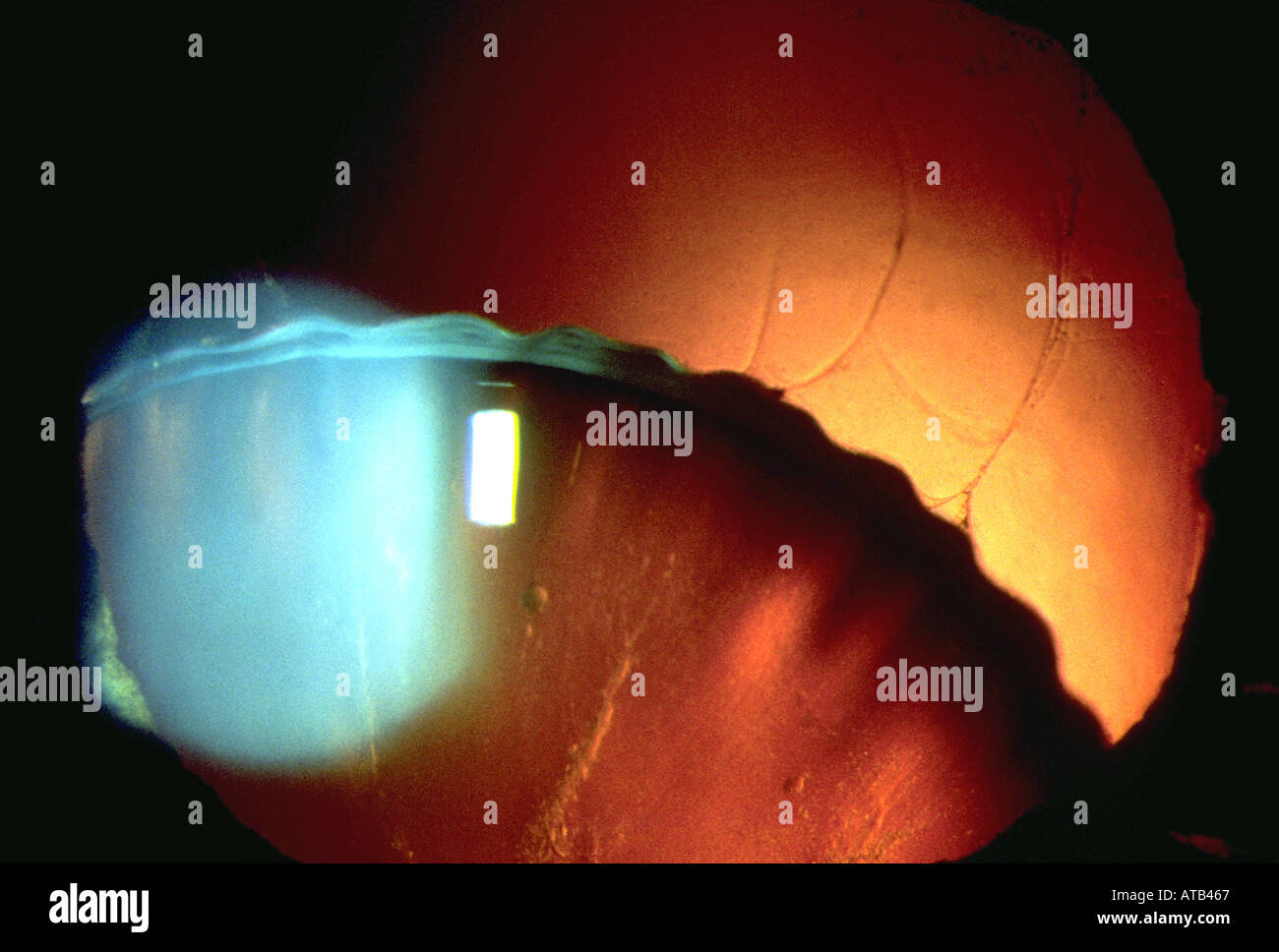 Dislocation lens hi-res stock photography and images - Alamy