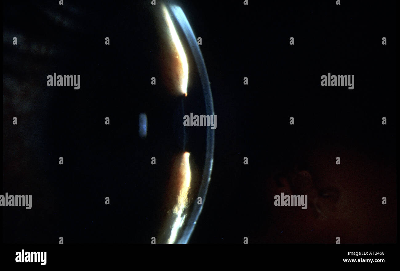 Anterior chamber of the eye hi-res stock photography and images - Alamy