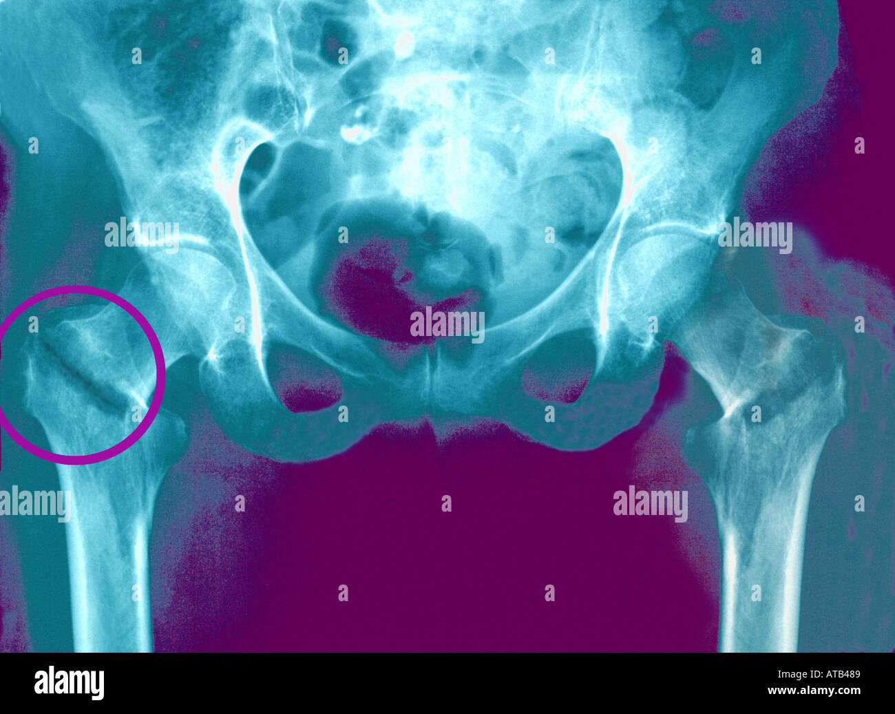 X ray bilateral fractured neck of femur Stock Photo - Alamy