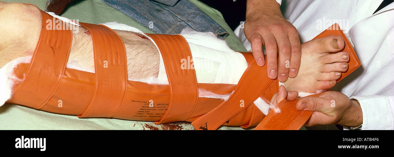 Fractured tibia hi-res stock photography and images - Alamy