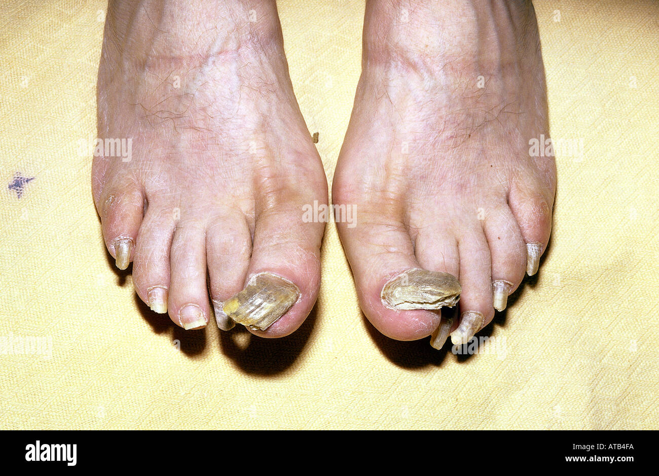 Thickened toenails hi-res stock photography and images - Alamy
