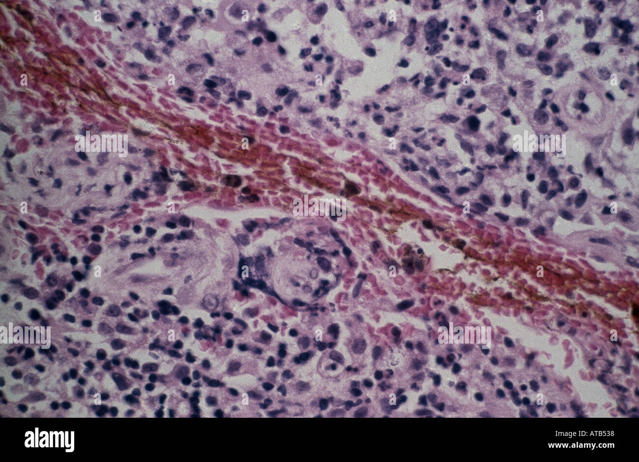 Photomicrograph conjunctival tuberculosis Stock Photo - Alamy