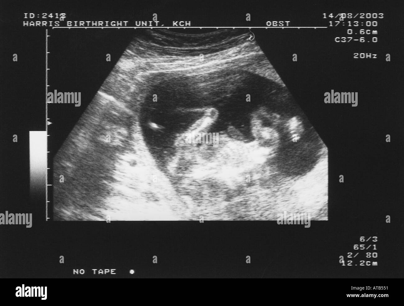 Ultrasound scan amniocentesis Stock Photo - Alamy