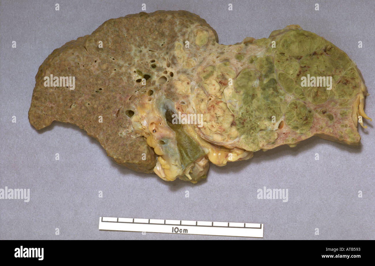 Liver specimen hepatoma with macronodular cirrhosis Stock Photo - Alamy
