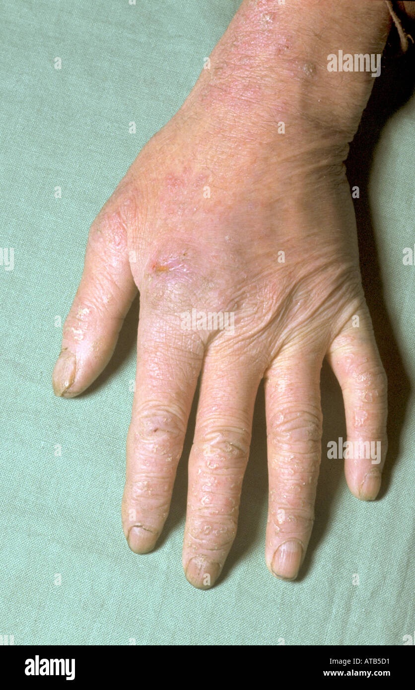 Hand squamous cell carcinoma hi-res stock photography and images - Alamy