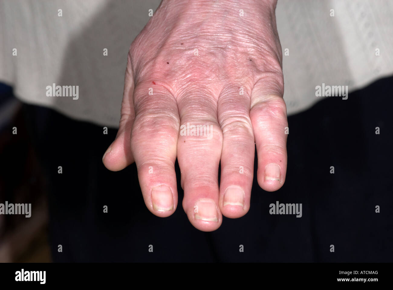 Swollen finger joints hi-res stock photography and images - Alamy
