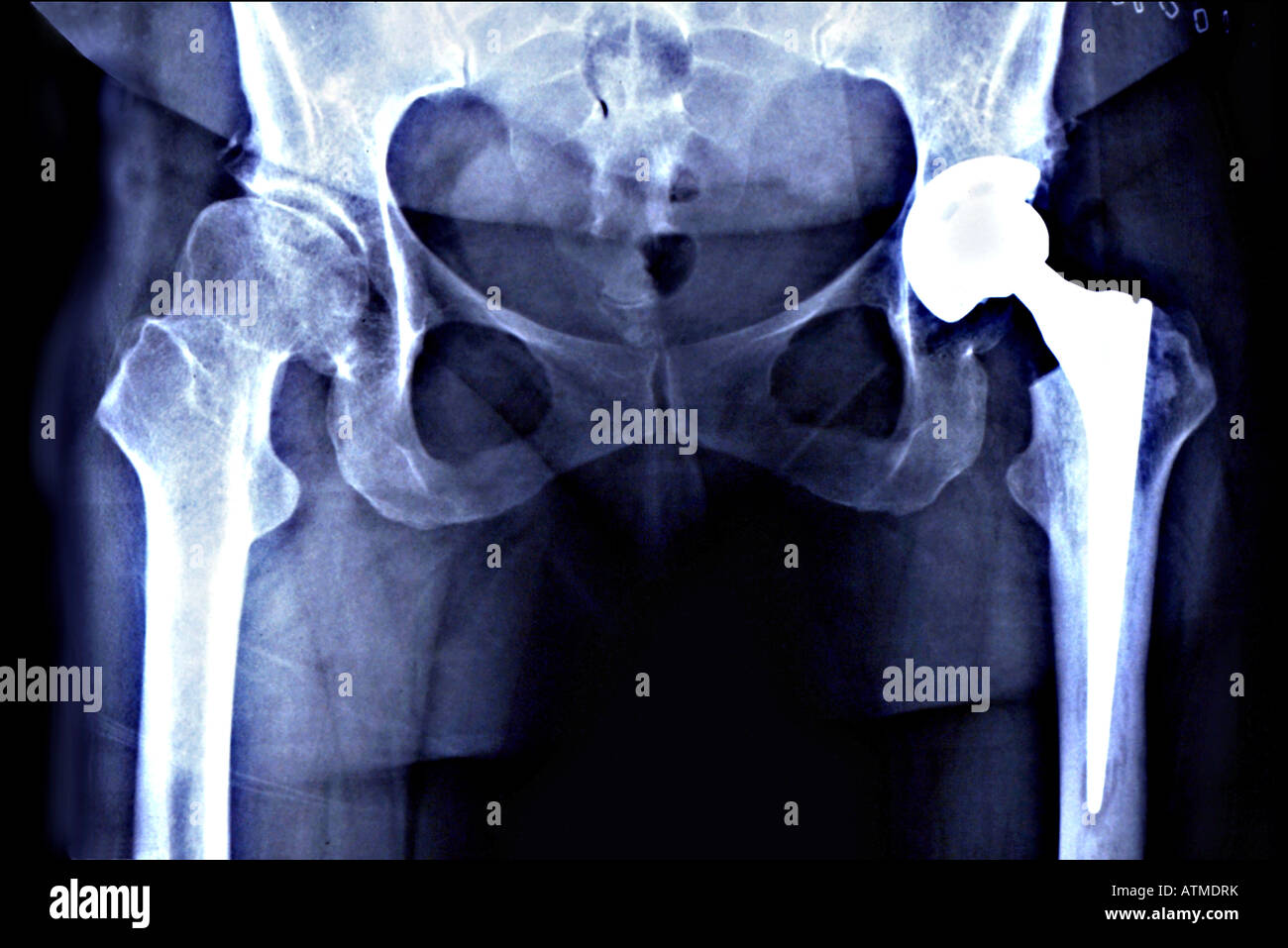 Joint replacement operation hi-res stock photography and images - Alamy