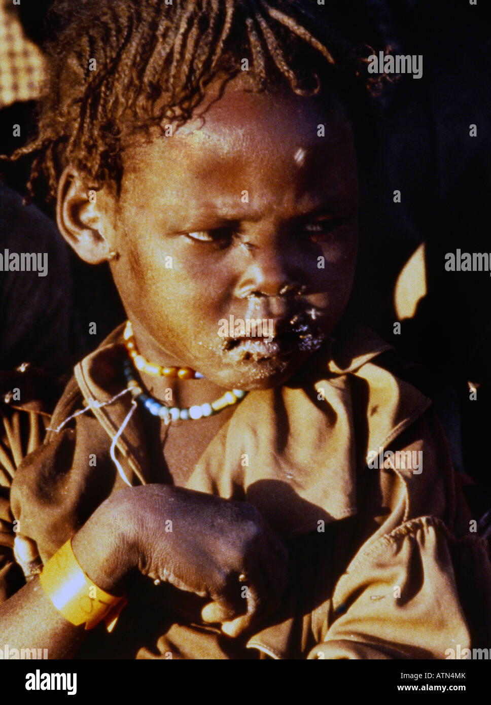 Marasmus hi-res stock photography and images - Alamy