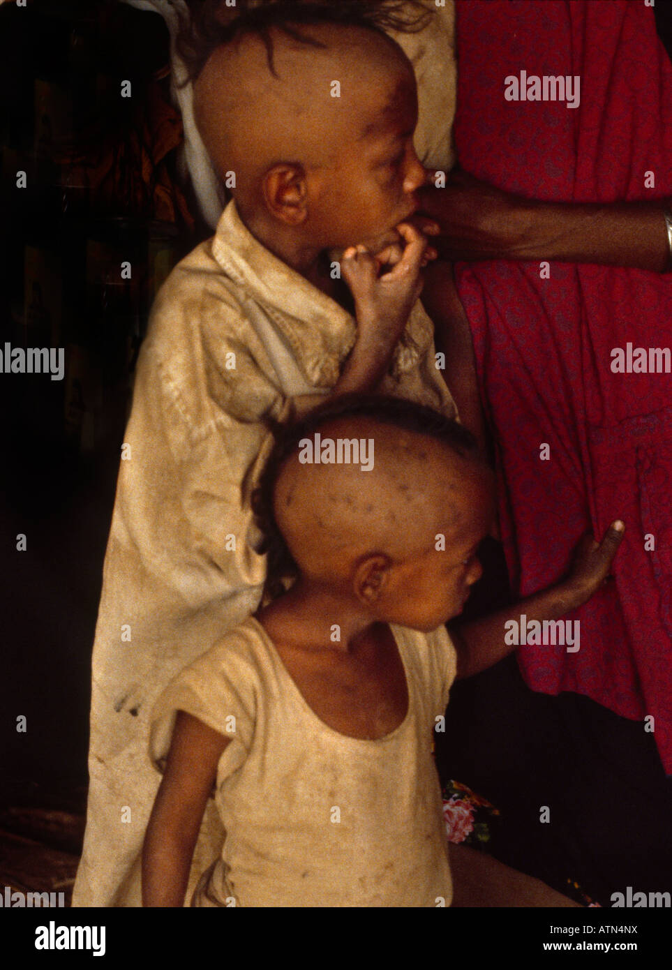 Ringworm child hi-res stock photography and images - Alamy