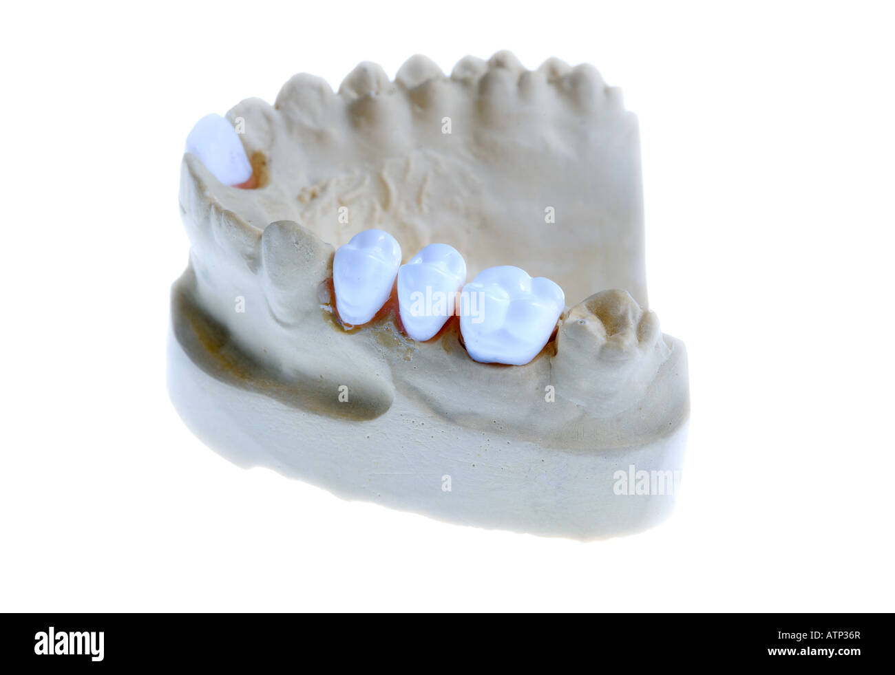 Dental tooth implants in a mold of a persons mouth on white background ...