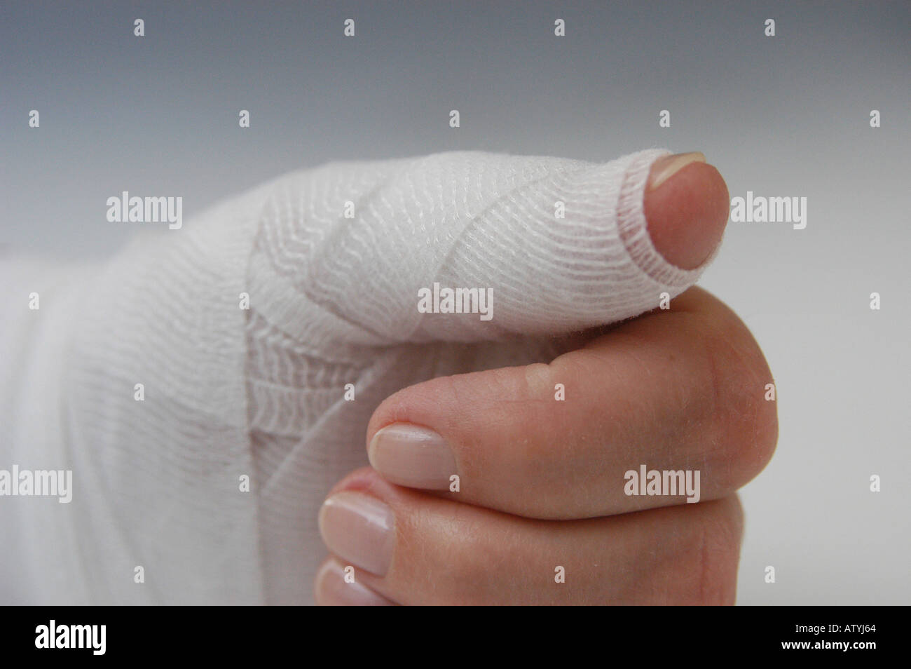 Handverletzung Verband Verletzung verletzt Unfall Arbeitsunfall Stock Photo - Alamy