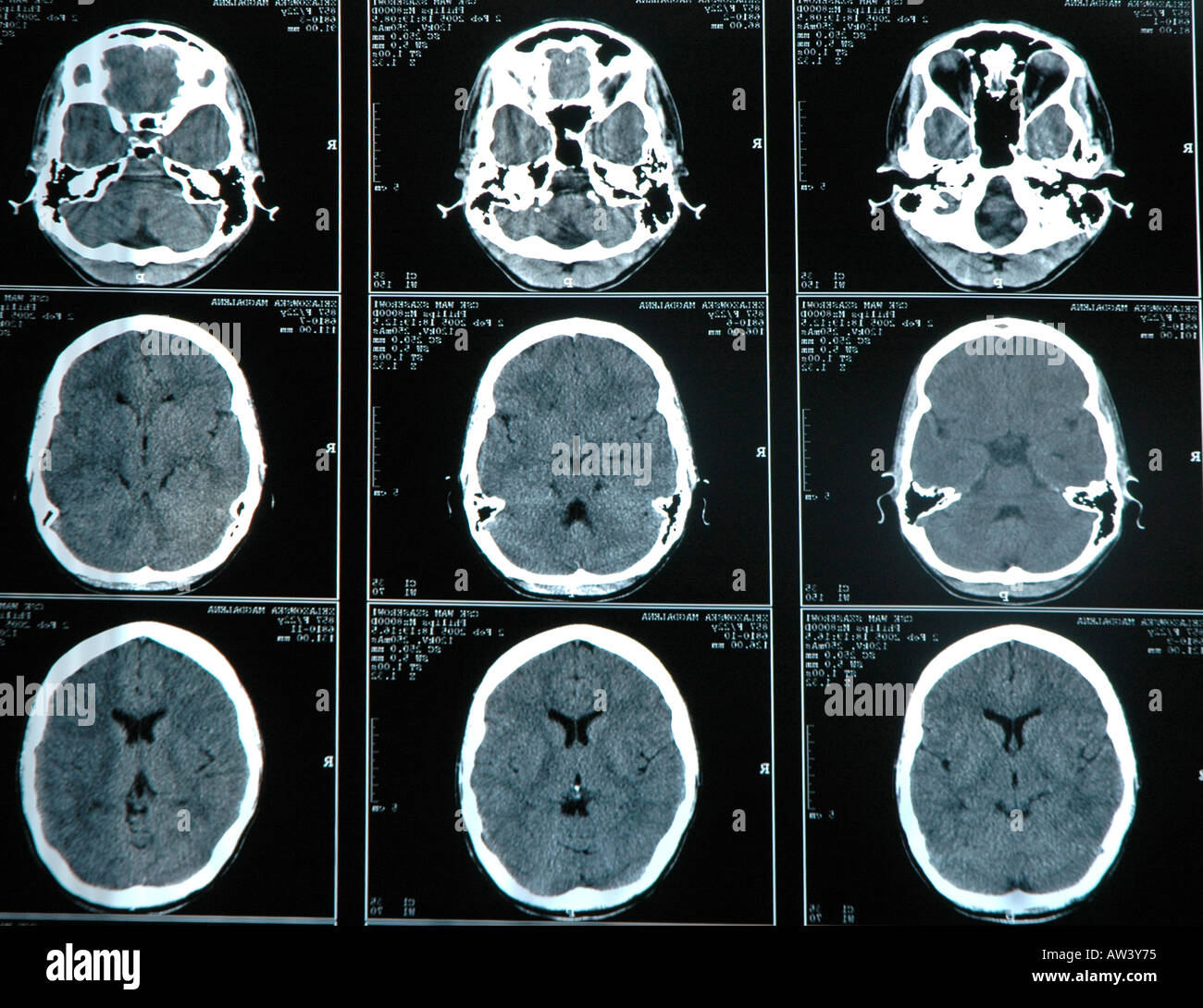 computer tomography CT photography of human brain Stock Photo - Alamy