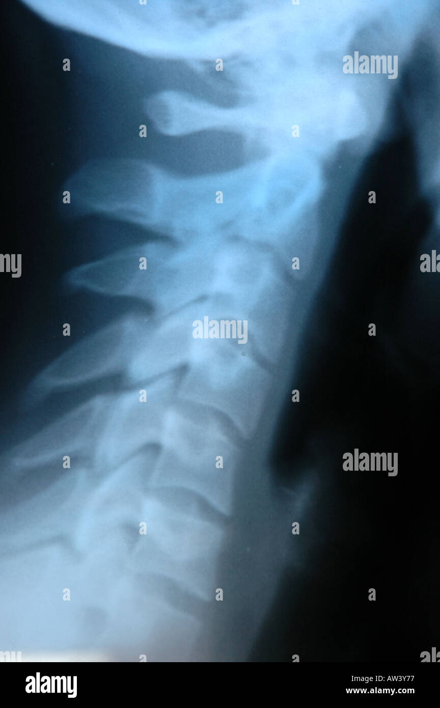 X ray photograph hi-res stock photography and images - Alamy
