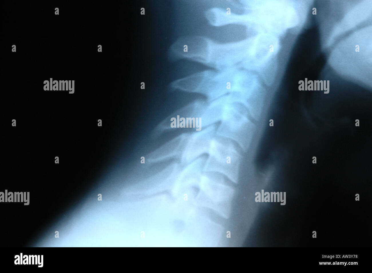 X-ray photography of human backbone Stock Photo - Alamy