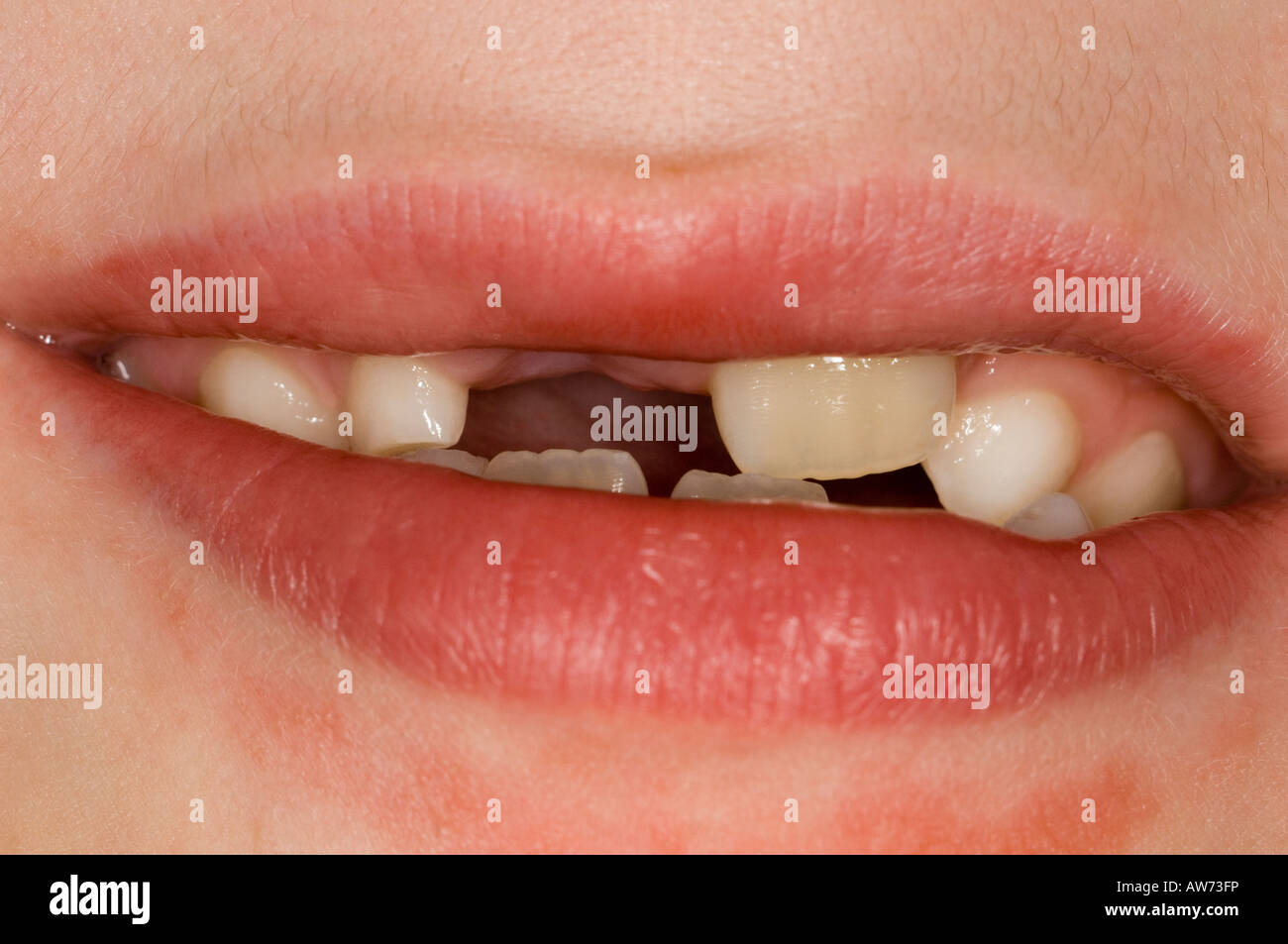 British Teeth Vs American Teeth