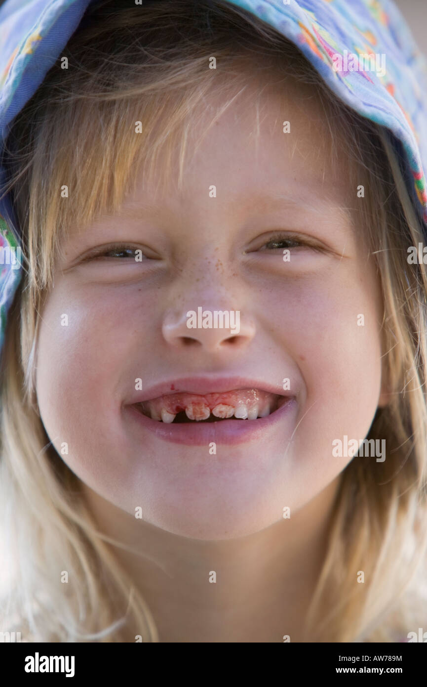Lost teeth hi-res stock photography and images - Alamy
