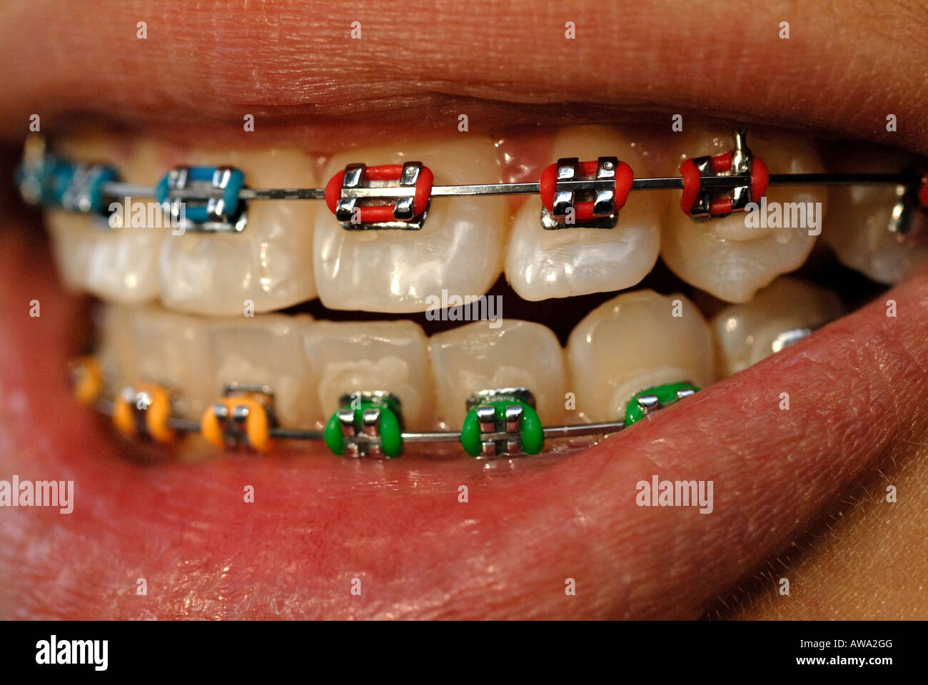 Colourful braces hi-res stock photography and images - Alamy
