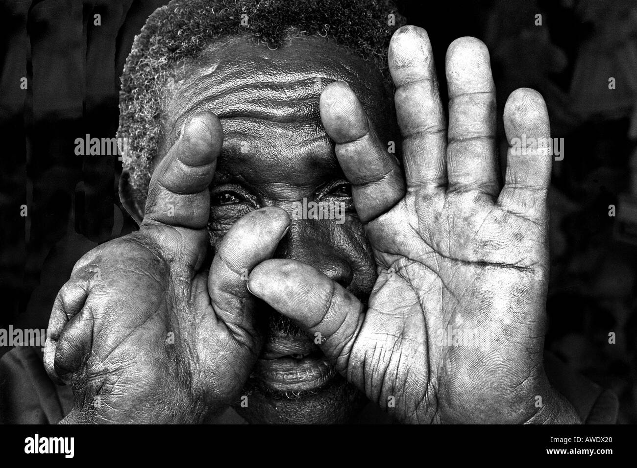 Portrait of a war victim showing his injured hands, Africa Stock Photo ...
