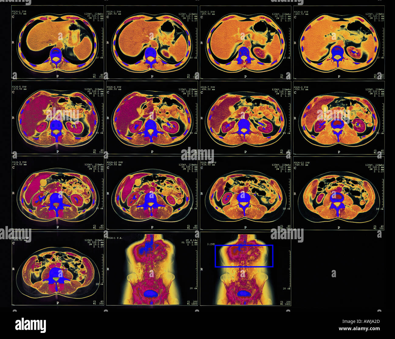 Cat scan of abdominal area Stock Photo - Alamy