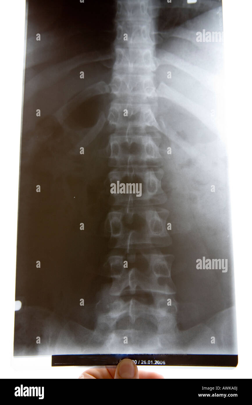 copy from an x-ray Stock Photo - Alamy