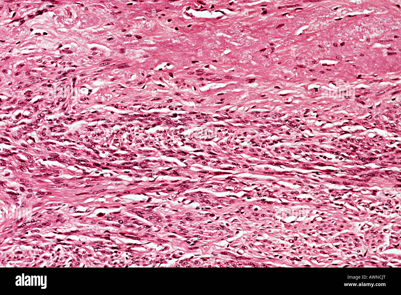 Myometrium hi-res stock photography and images - Alamy