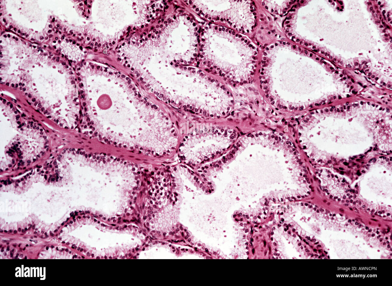 Microscopic prostate hi-res stock photography and images - Alamy