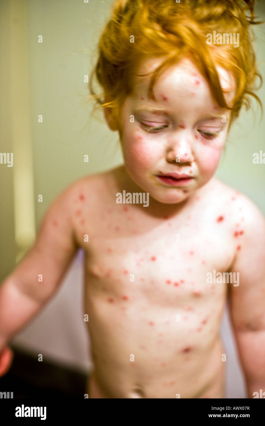 three year old girl with chicken pox Stock Photo - Alamy