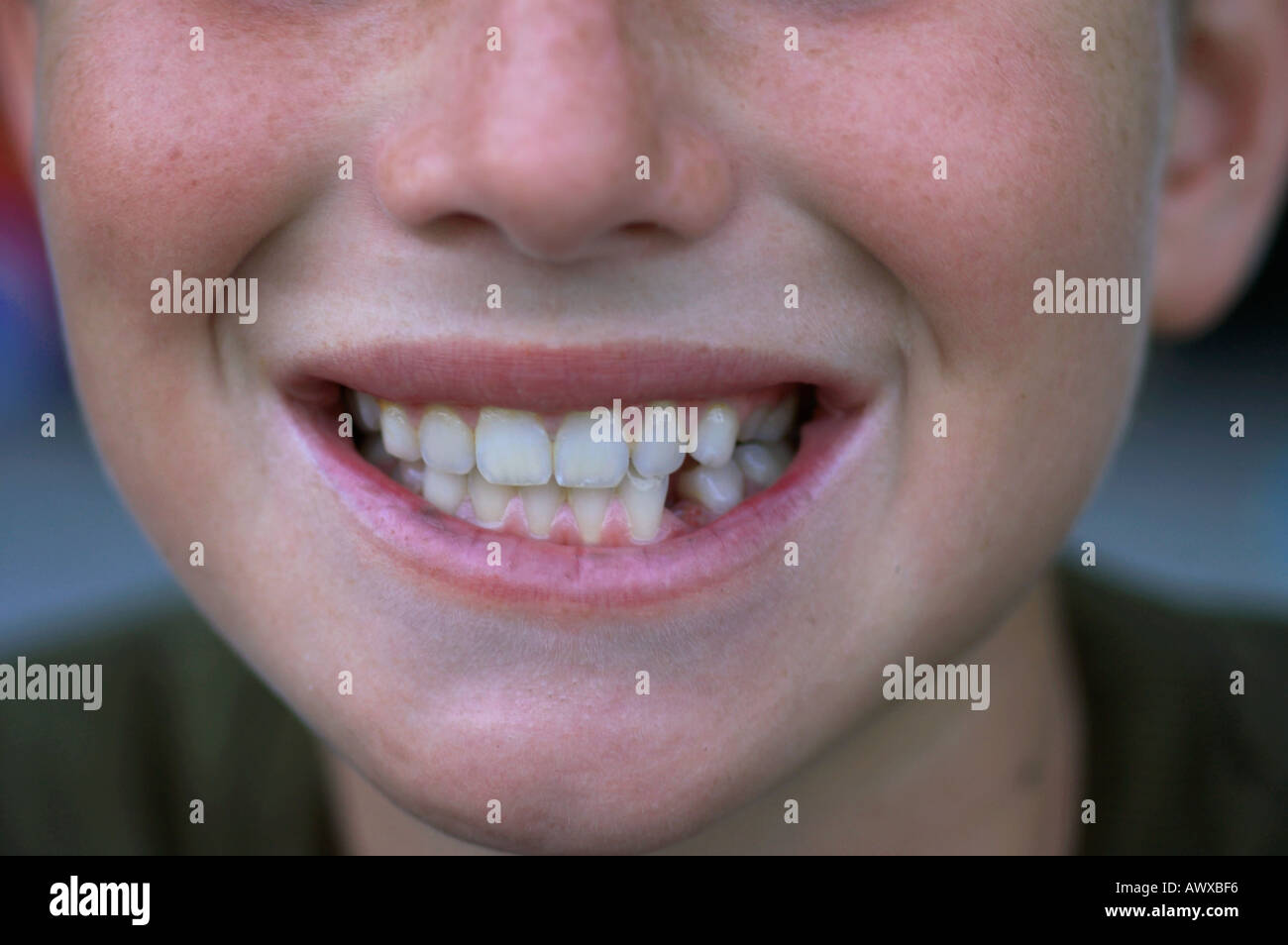 boy with tooth missing Stock Photo - Alamy