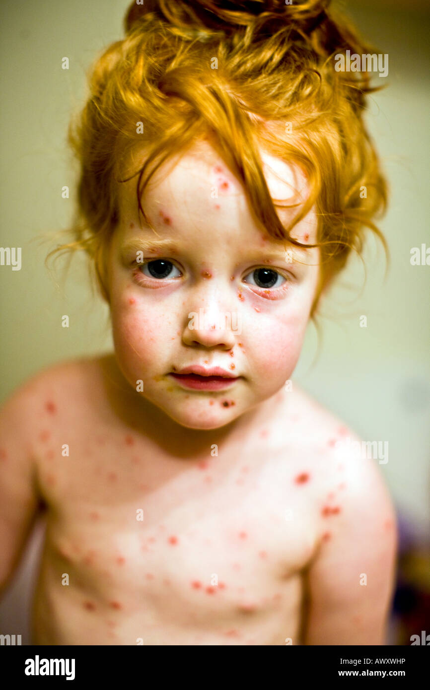 three year old girl covered with chickenpox Stock Photo - Alamy