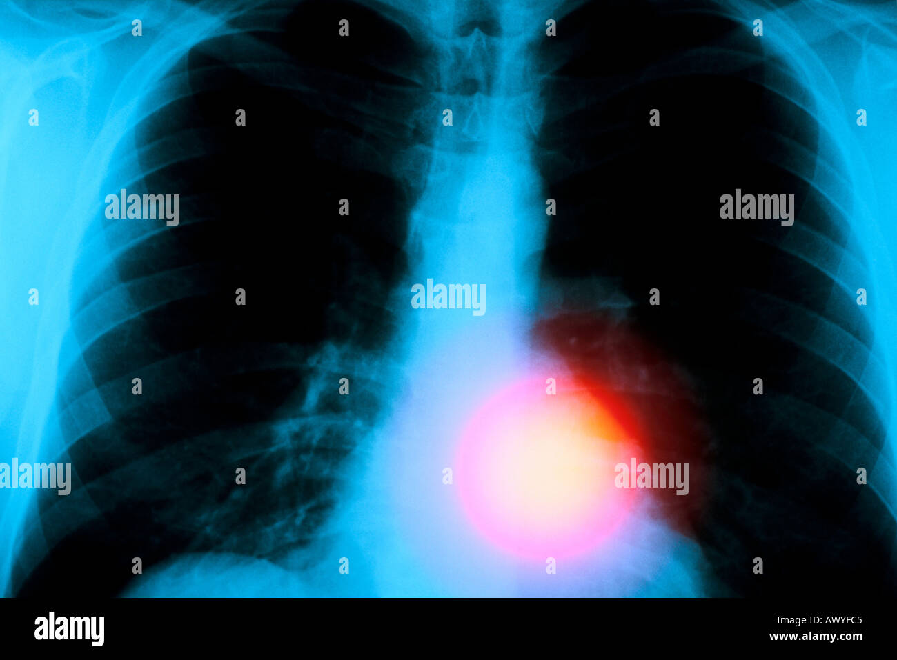 A red glow over the heart area of a chest x ray Stock Photo - Alamy