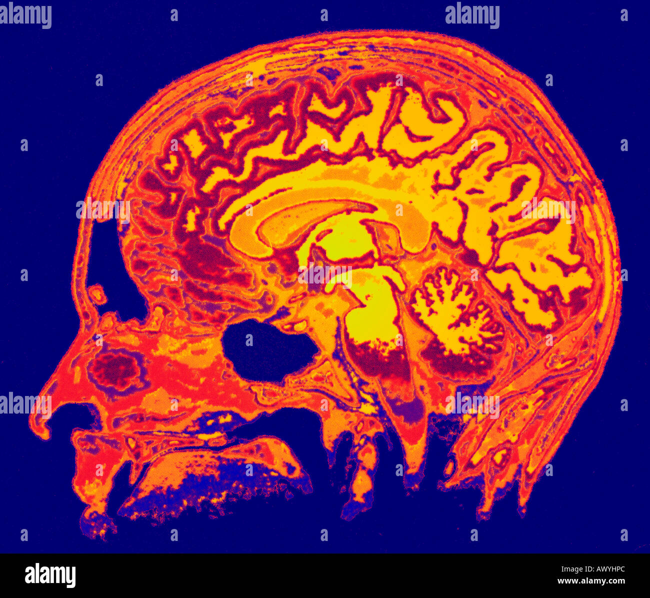 x-ray of human skull with color code Stock Photo - Alamy