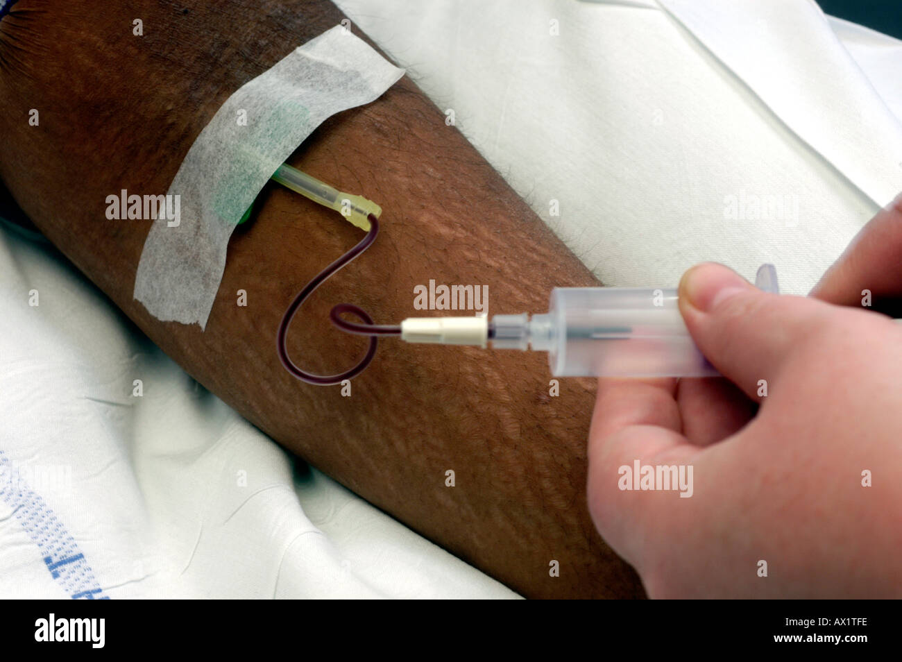 Patient having butterfly inserted into vein Stock Photo - Alamy