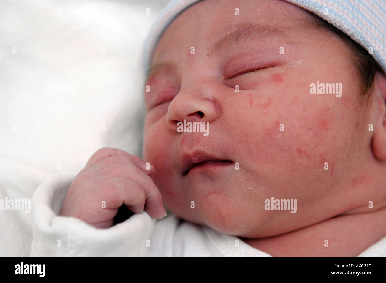 Baby acne hi-res stock photography and images - Alamy