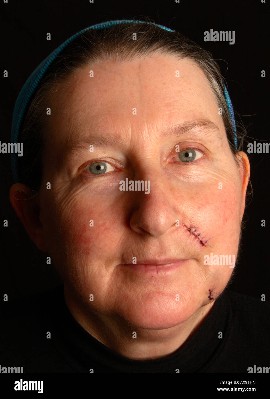 Face stitches hi-res stock photography and images - Alamy