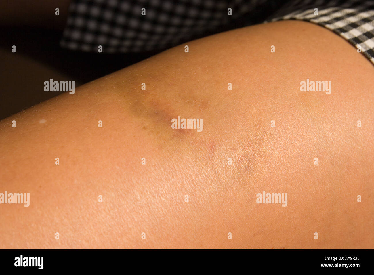 A woman showing a bruise on her thigh Left leg Stock Photo - Alamy