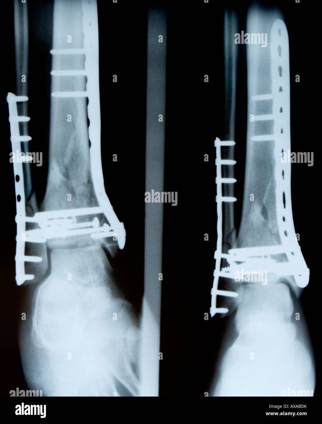 Xray plate negative hi-res stock photography and images - Alamy