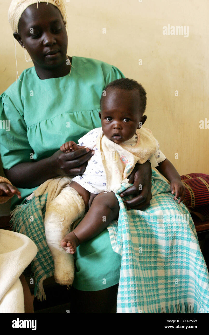 Clubfoot treatment at the Moi University Hospital in Eldoret, Kenia ...