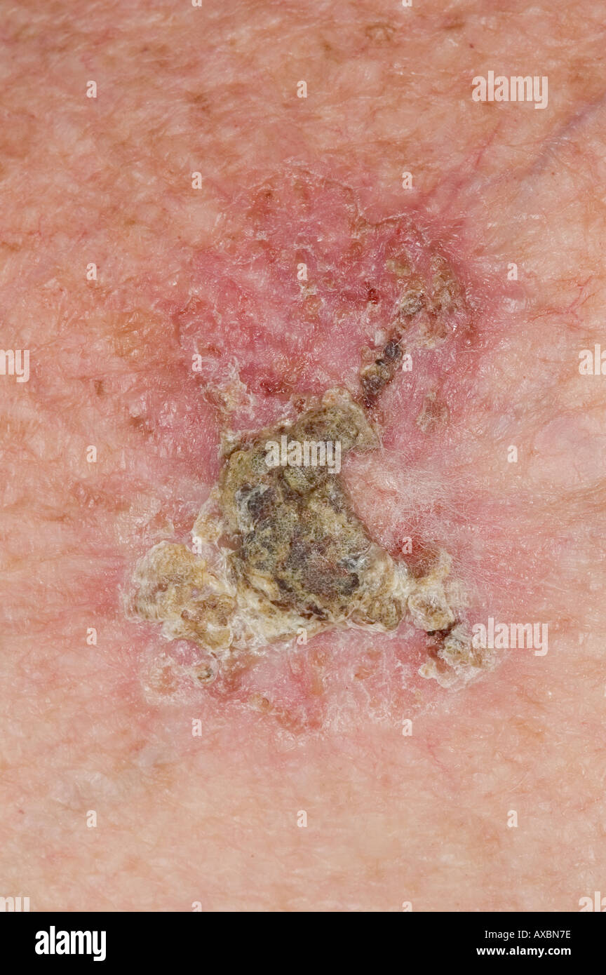 Actinic keratosis hi-res stock photography and images - Alamy