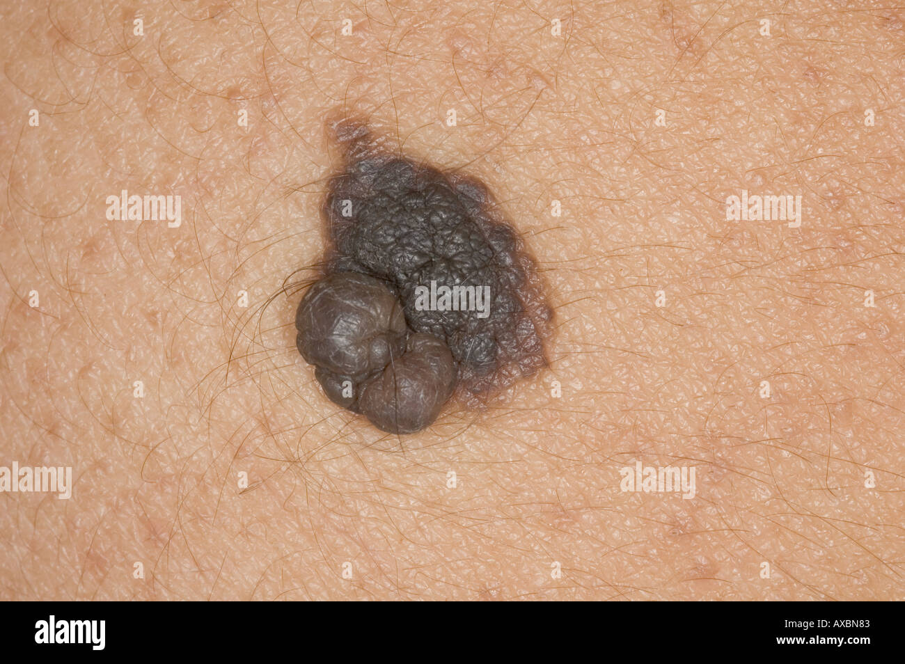 Melanocytic Naevus Stock Photo: 5482882 - Alamy