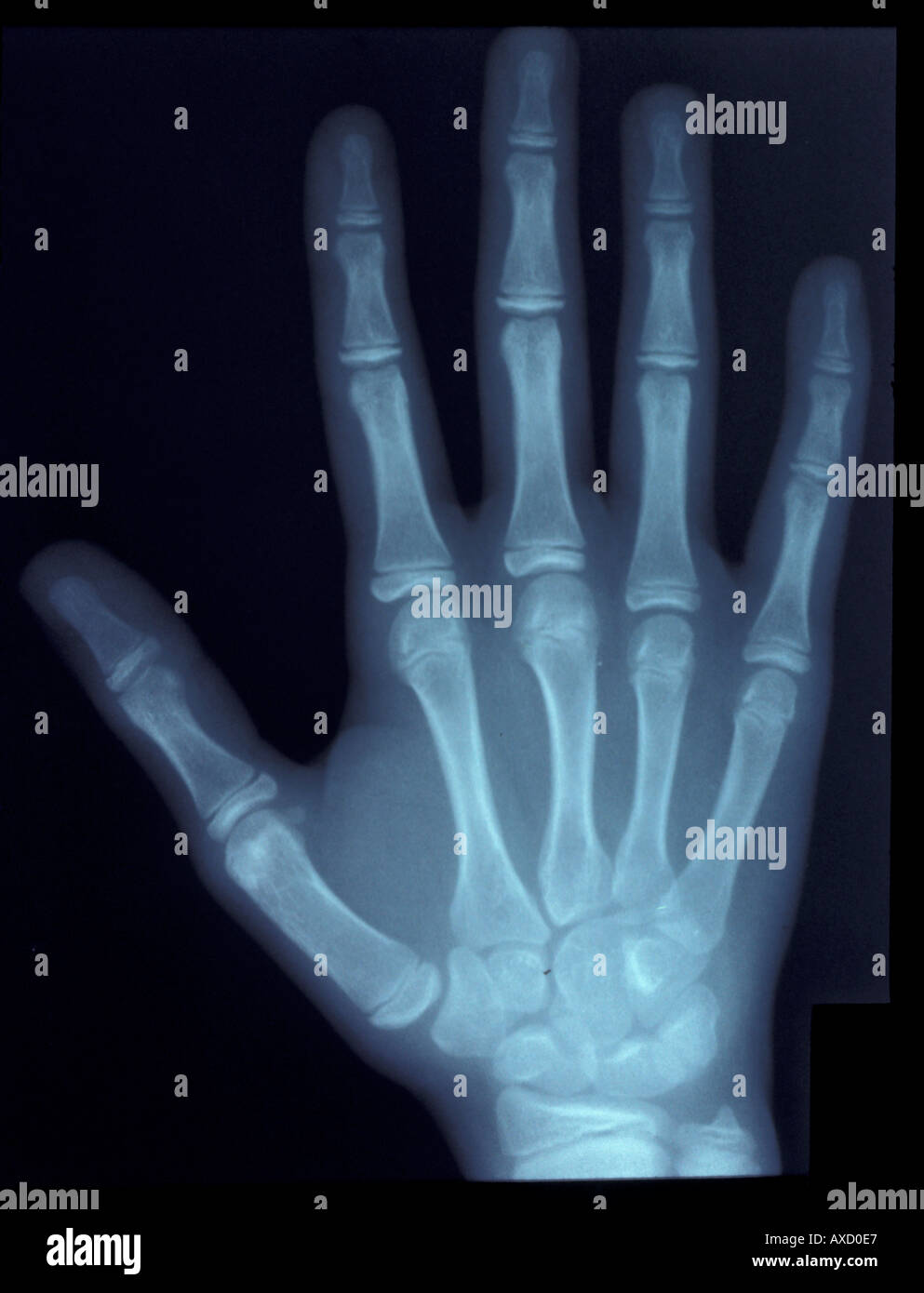Science Medical X ray of hand Stock Photo - Alamy