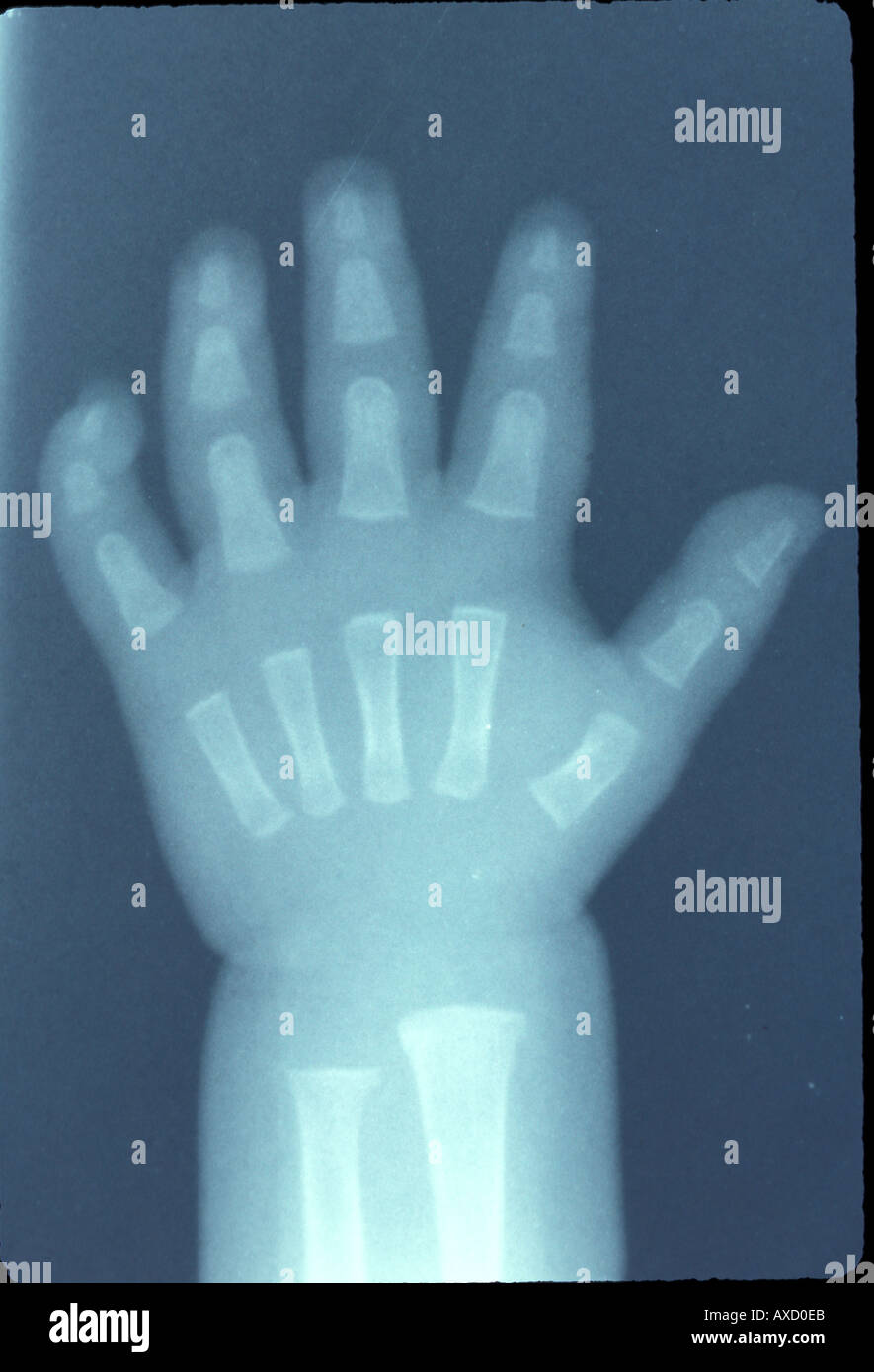 Science Medical X ray of hand Stock Photo - Alamy