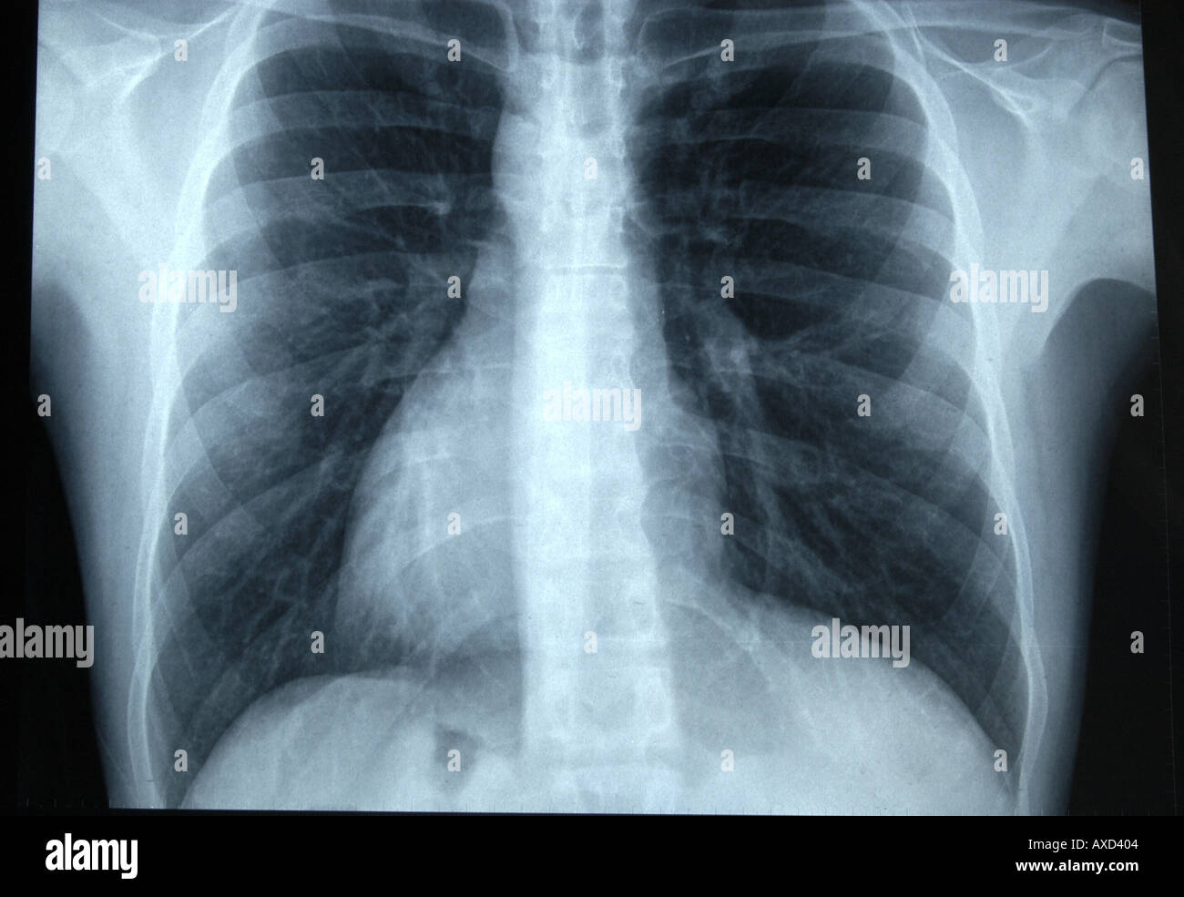 Radiograph of healthy lungs of a male in his late twenties Stock Photo ...