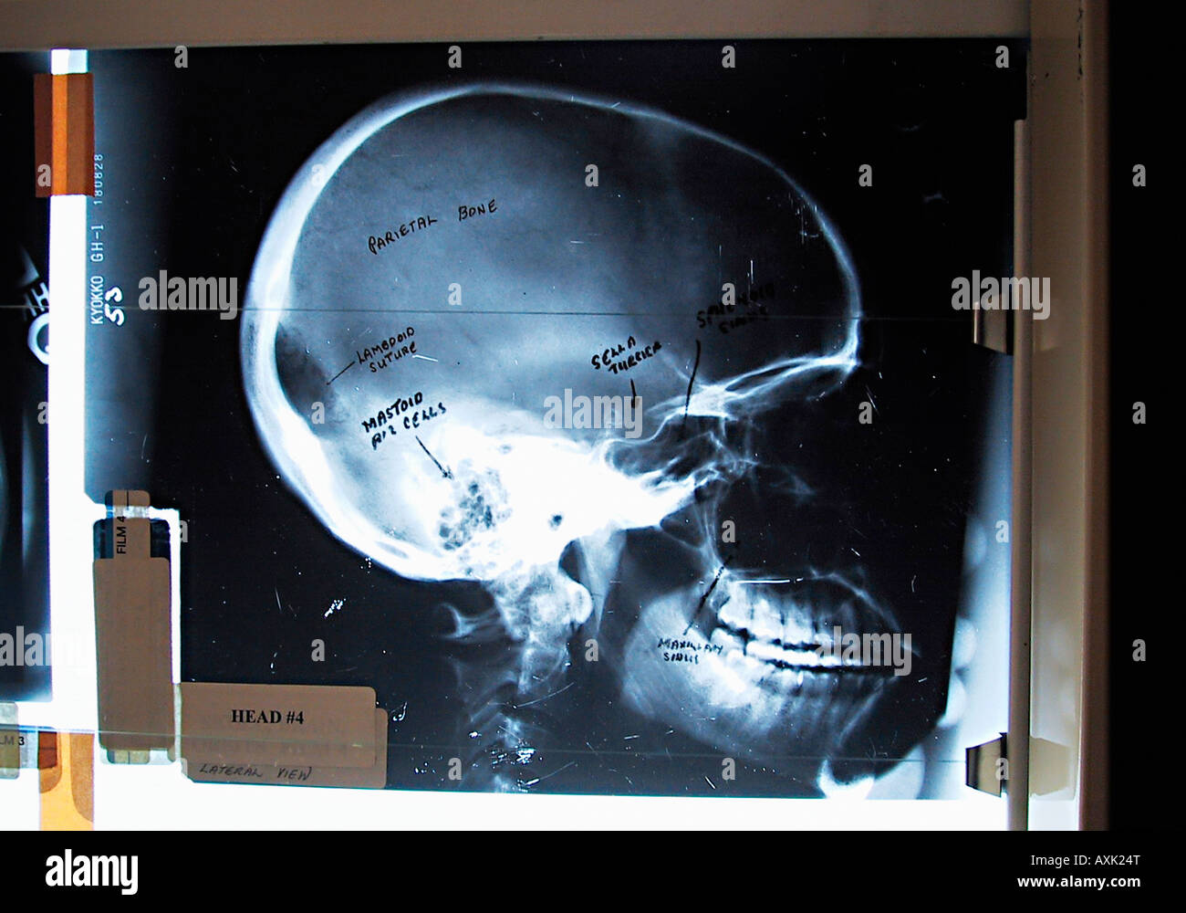 x ray of scull and neck Stock Photo - Alamy
