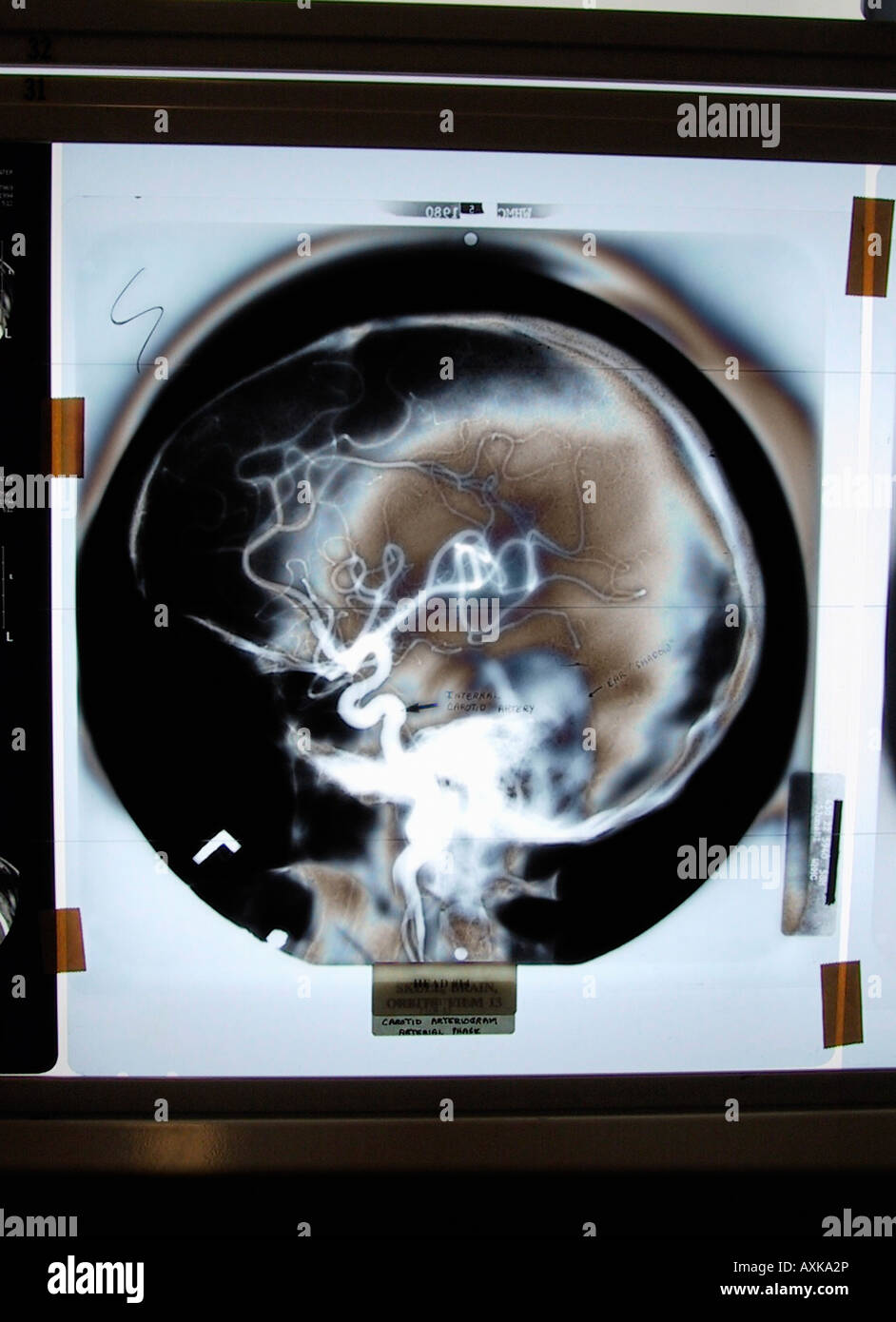 Skull fracture xray hi-res stock photography and images - Alamy