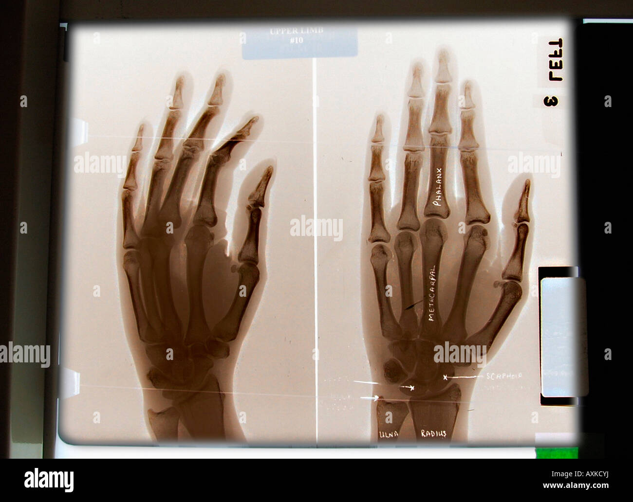 x ray of hands Stock Photo - Alamy