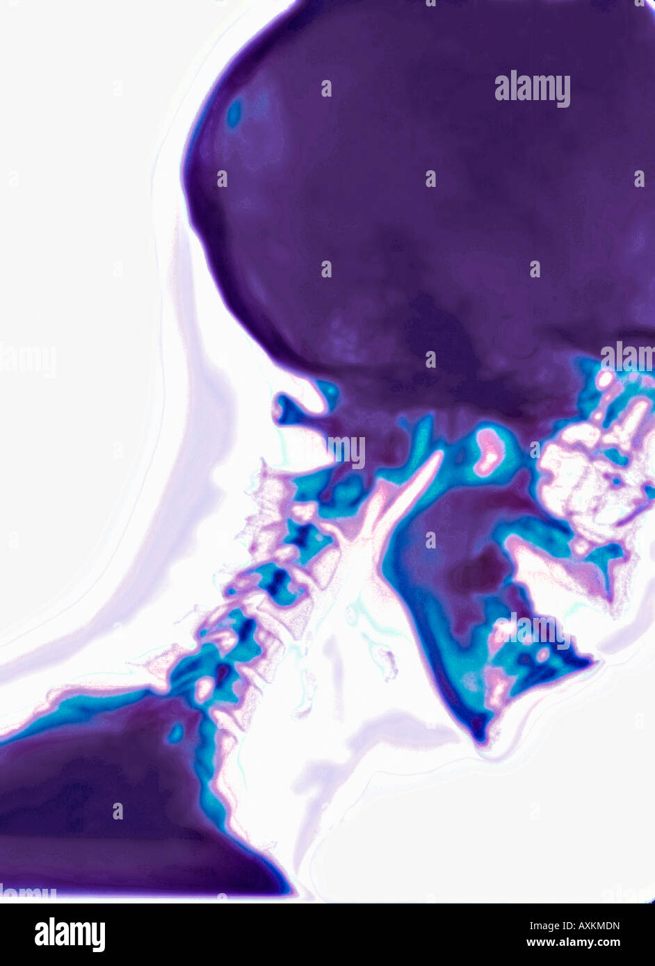 x ray of scull and neck Stock Photo - Alamy