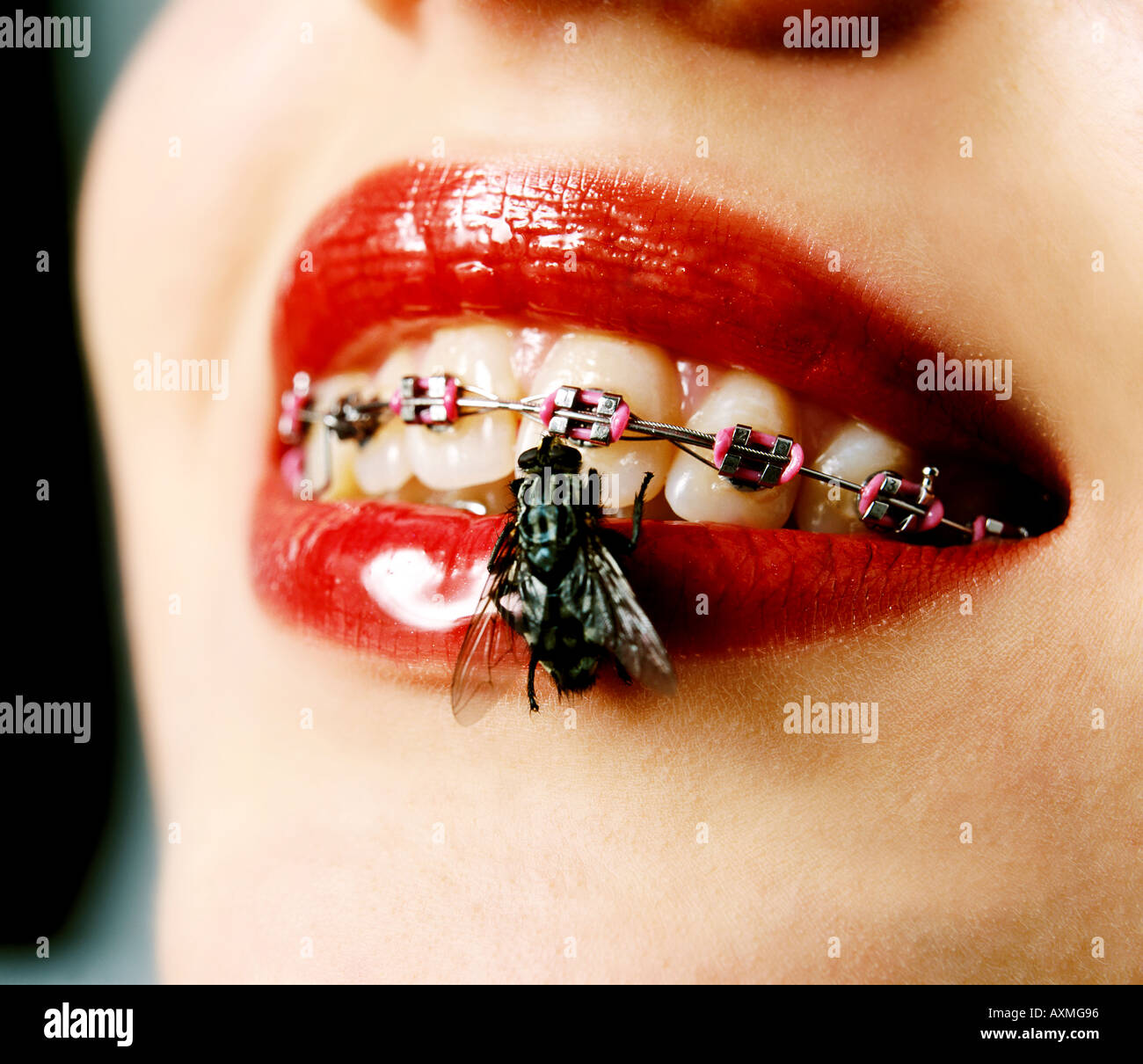 Teeth brace hi-res stock photography and images - Alamy