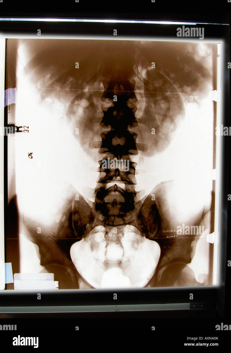 x ray of abdomen Stock Photo - Alamy